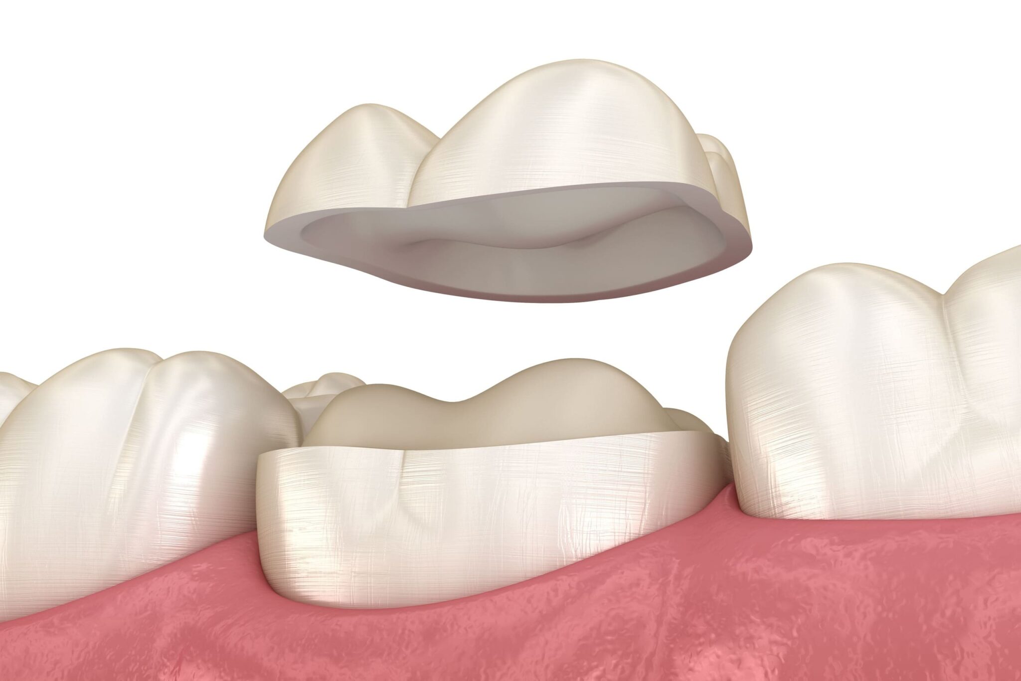 How Dental Crowns Can Save Damaged Teeth from Extraction - Dental Care ...